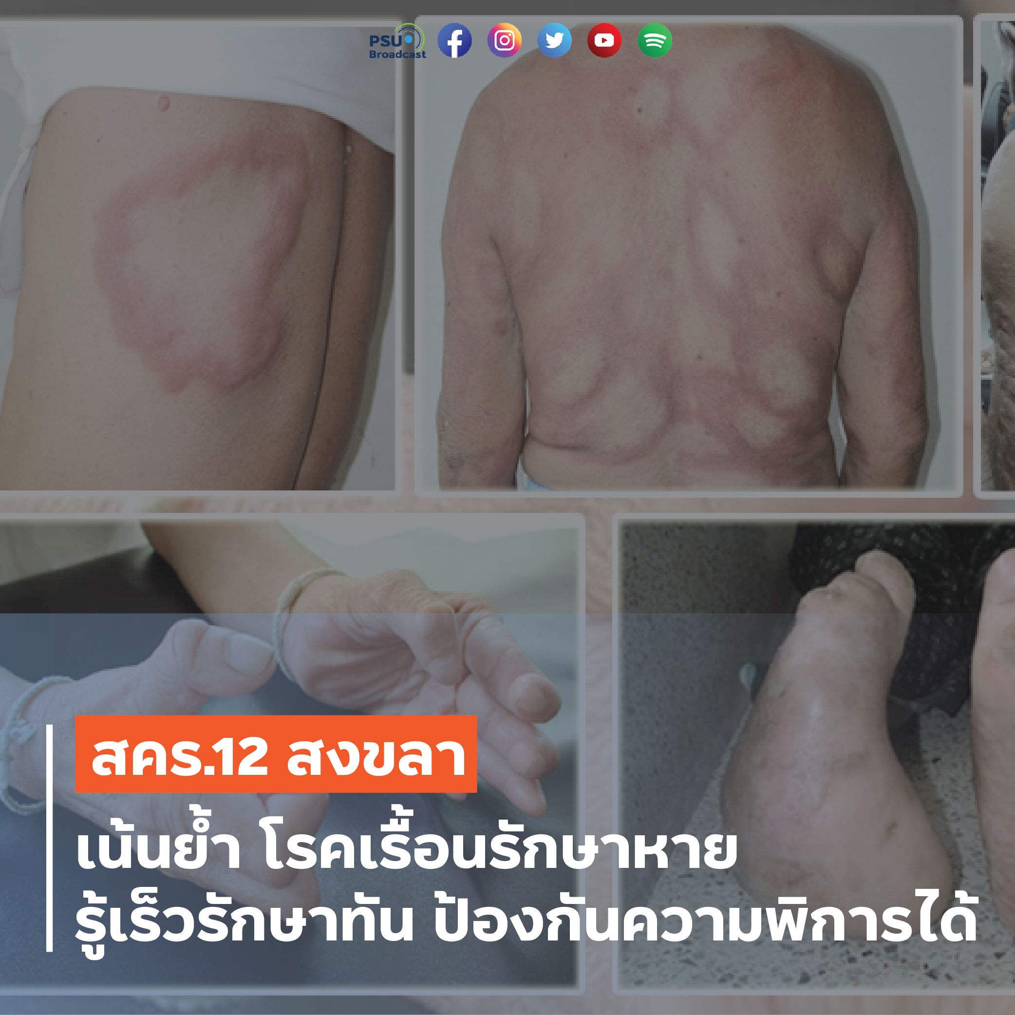 สคร.12 สงขลา เน้นย้ำ โรคเรื้อนรักษาหาย รู้เร็วรักษาทัน ป้องกันความพิการ ...